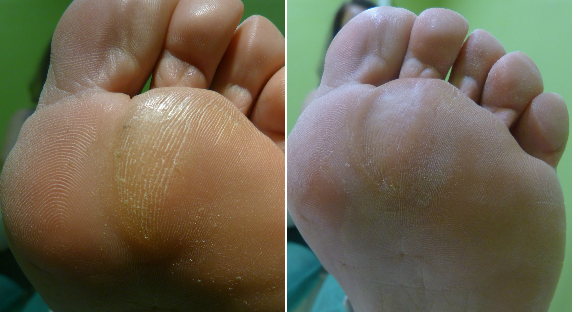 Hiperqueratosis metatarsal antes y después - Centro Podológico Euskalduna